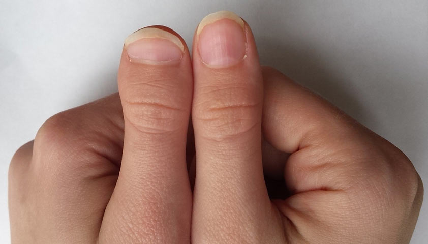 Брахидактилия: что это такое и как лечить